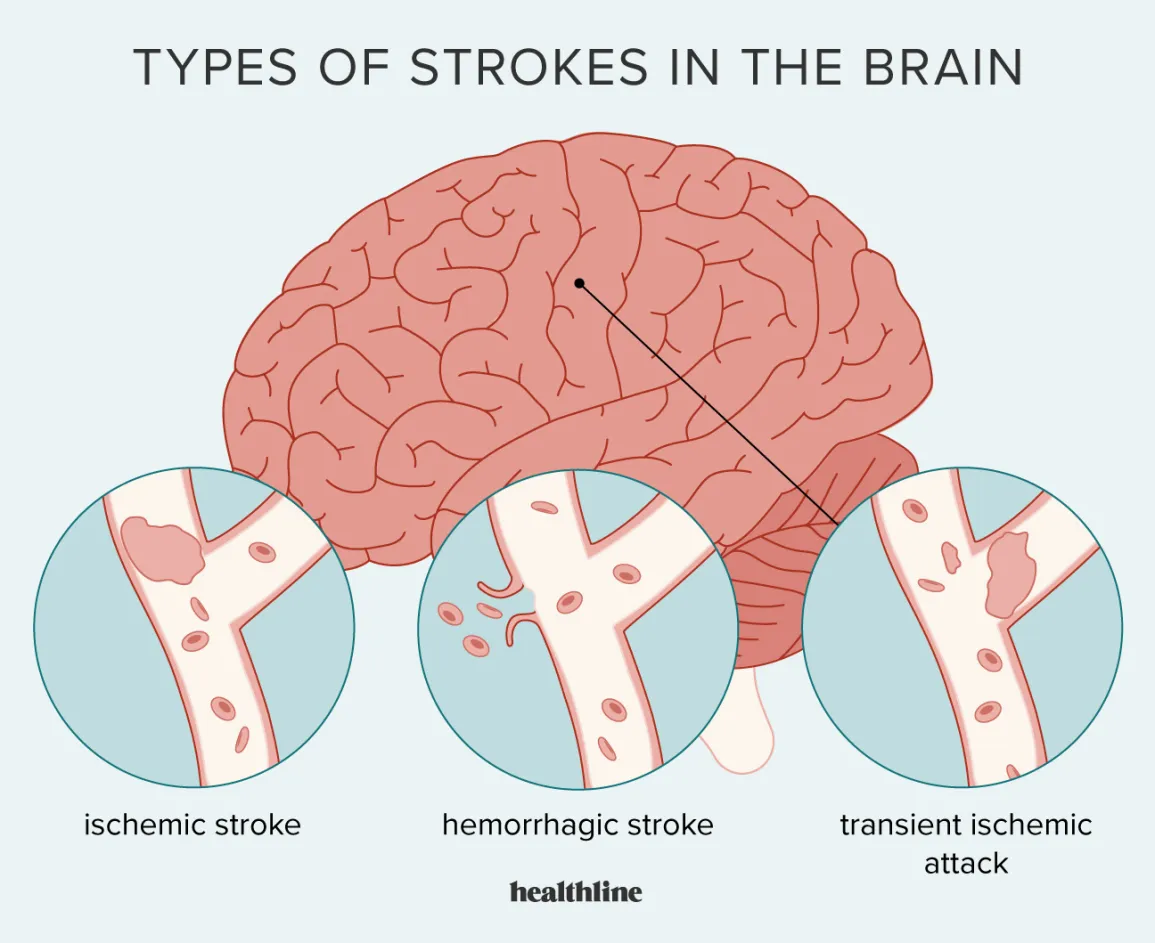 Are You at Risk? Genetics of Stroke – JP Stroke Foundation